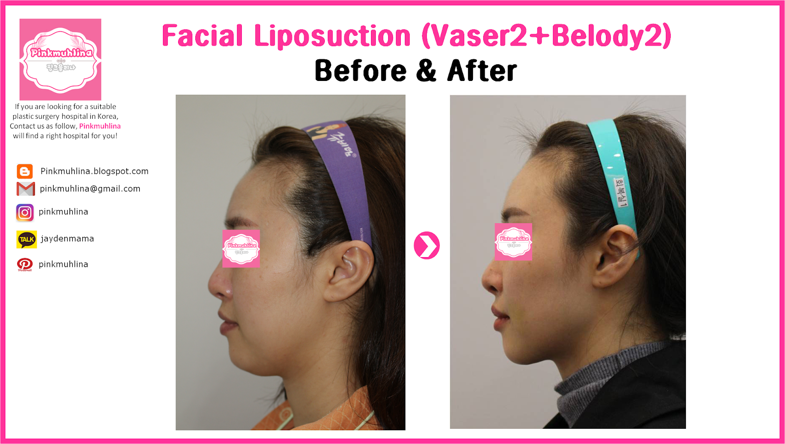 [Pinkmuhlina] Complete your perfect V Line without cutting bones ...