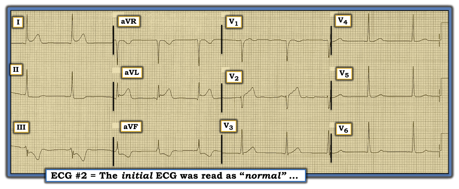 ECG Interpretation: ECG Blog #170 (Atypical Chest Pain - Mirror Image ...