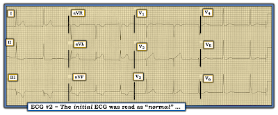 ECG Interpretation: ECG Blog #170 (Atypical Chest Pain - Mirror Image ...