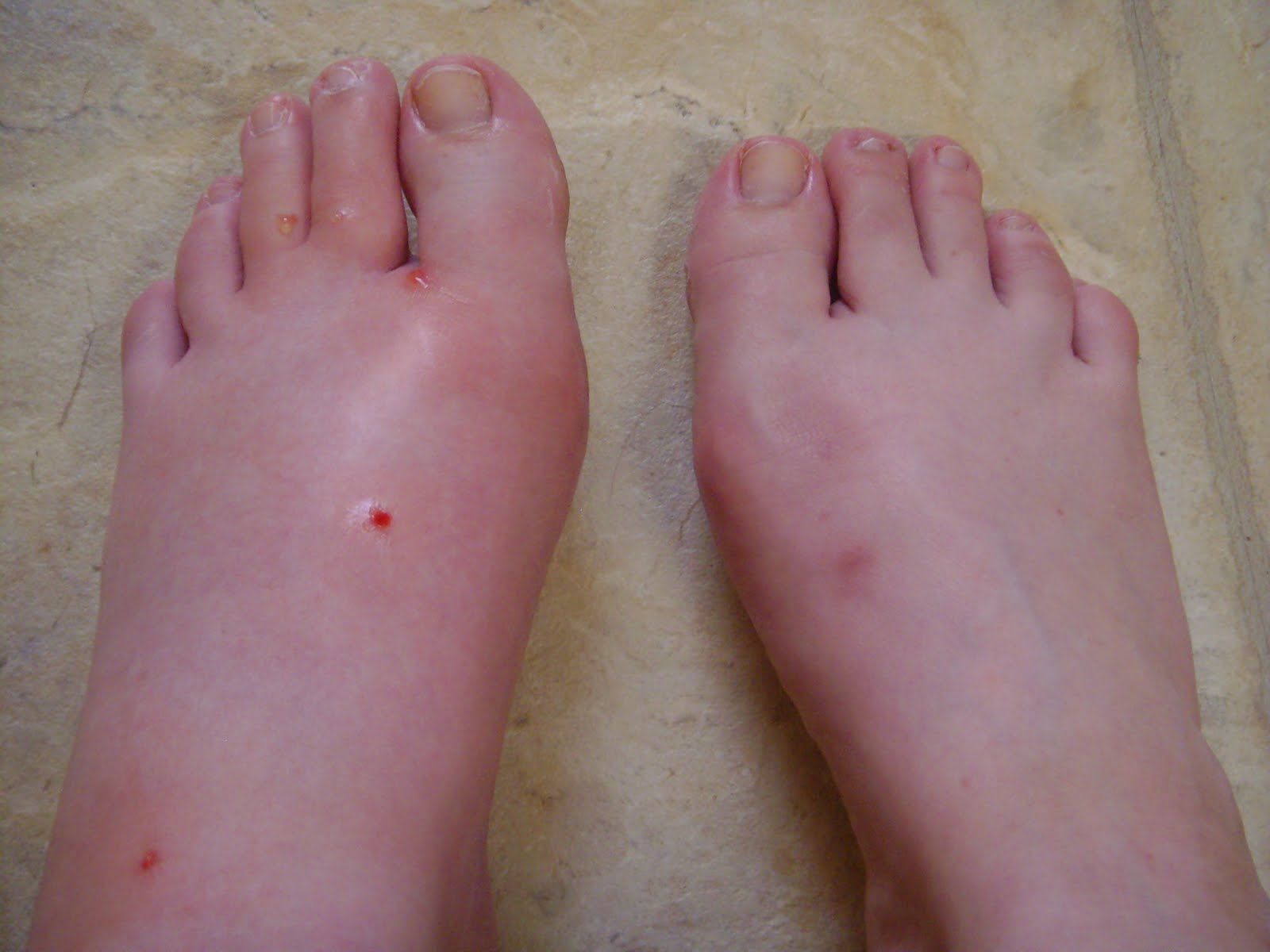 The Sly Fox Seven: Ant Bites