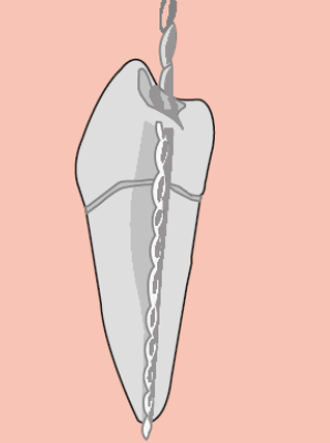 Errors in Access Cavity Preparation - Endodontics and Oral Implantology
