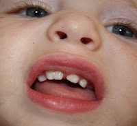 Chris M Jolley DDS: Double tooth