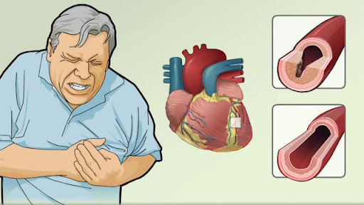 WHAT IS ANGINA? IS ANGINA DANGEROUS? CAUSES, SYMPTOMS, TYPES OF ANGINA ...
