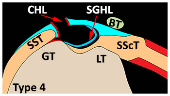 MRI Musculo-Skeletal Section: Long head of biceps dislocation grading.