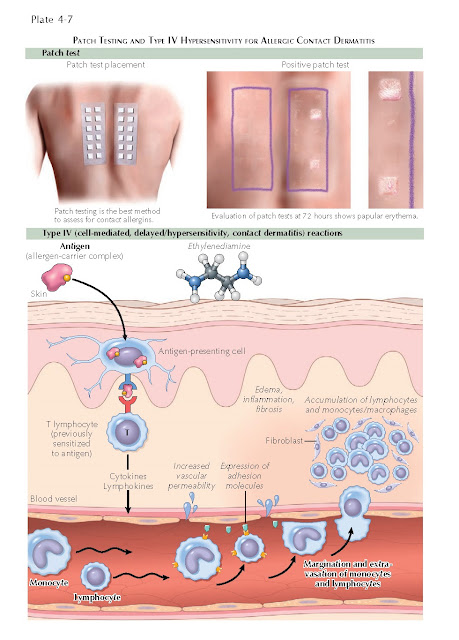 ALLERGIC CONTACT DERMATITIS - pediagenosis