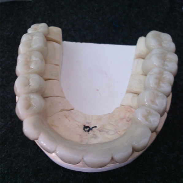 Dental PFM: Dental Porcelain Bonded to Metal Crown