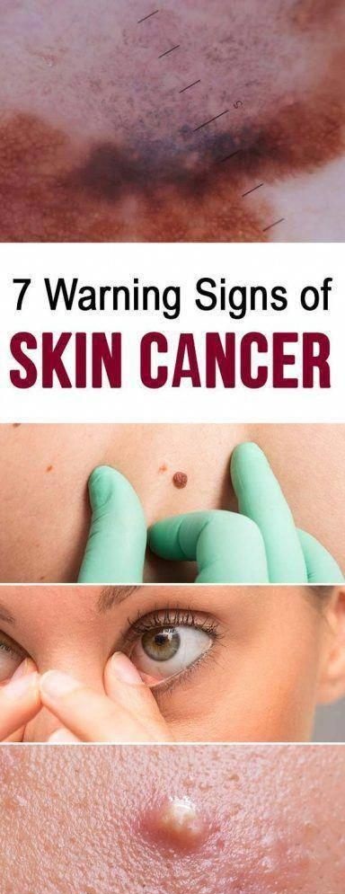 7 skin cancer warning signs you should never ignore - wellness magazine