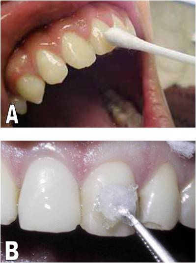 Dr. Miguel Irala - Odontología Moderna: ENDODONCIA