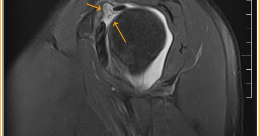 Adhesive Capsulitis: MRI - Sumer's Radiology Blog
