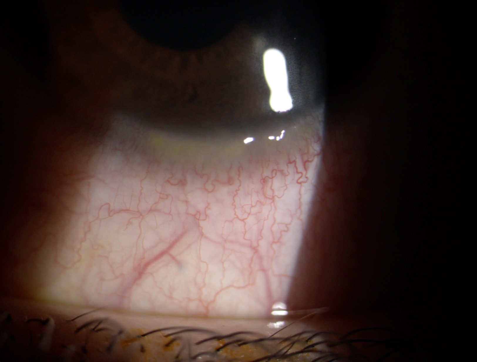 ULCERA MARGINAL (2FOTOS)