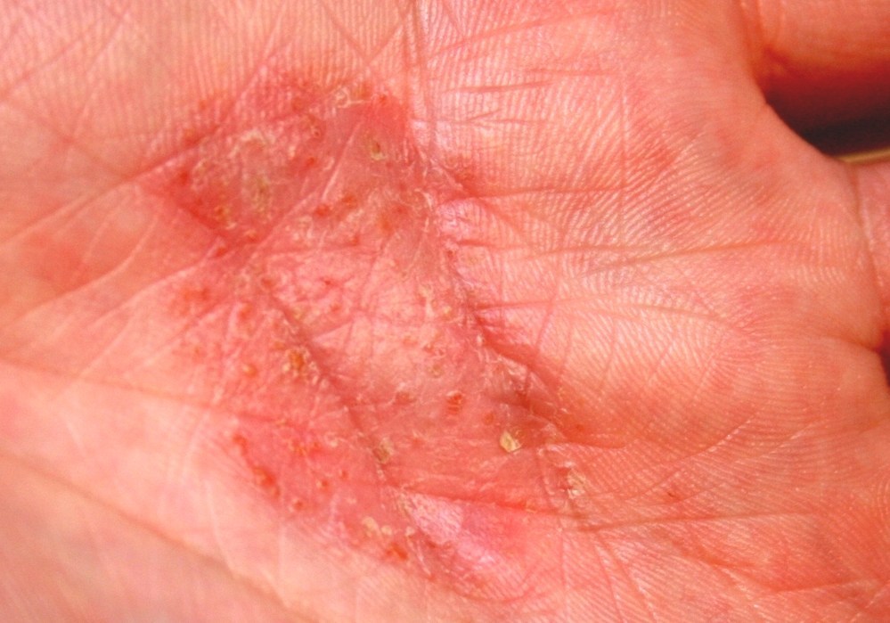 Hand Eczema Eczema On Hands Cure hand-eczema-eczema-on-hands-cure