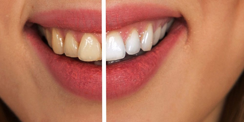 Dental Veneers In Turkey And Dentist Costs Geoffrey Chaucer dental-veneers-in-turkey-and-dentist-costs-geoffrey-chaucer