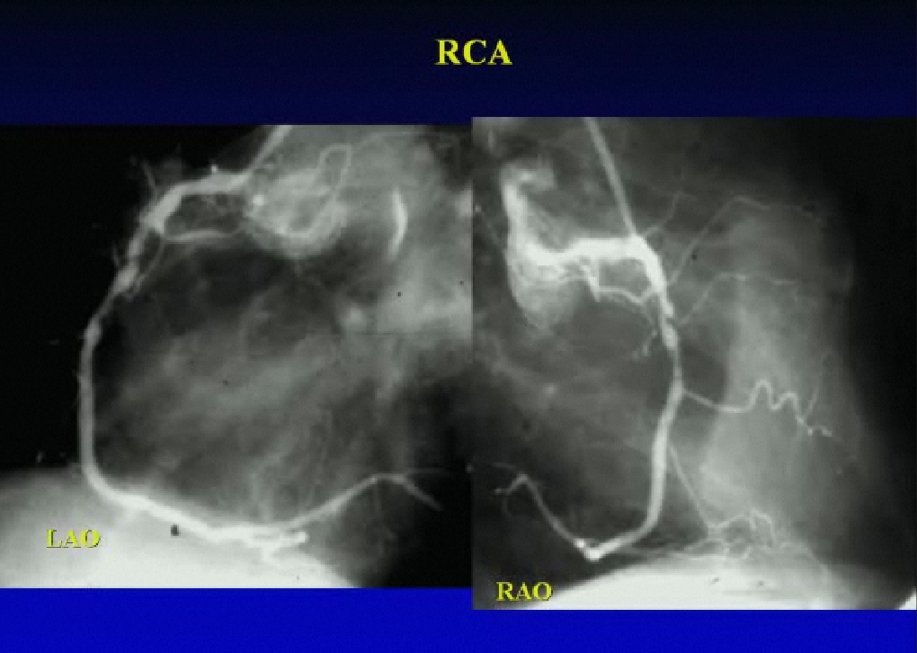 rsna: what radiologist knows about coronary artery (coronary artery ...