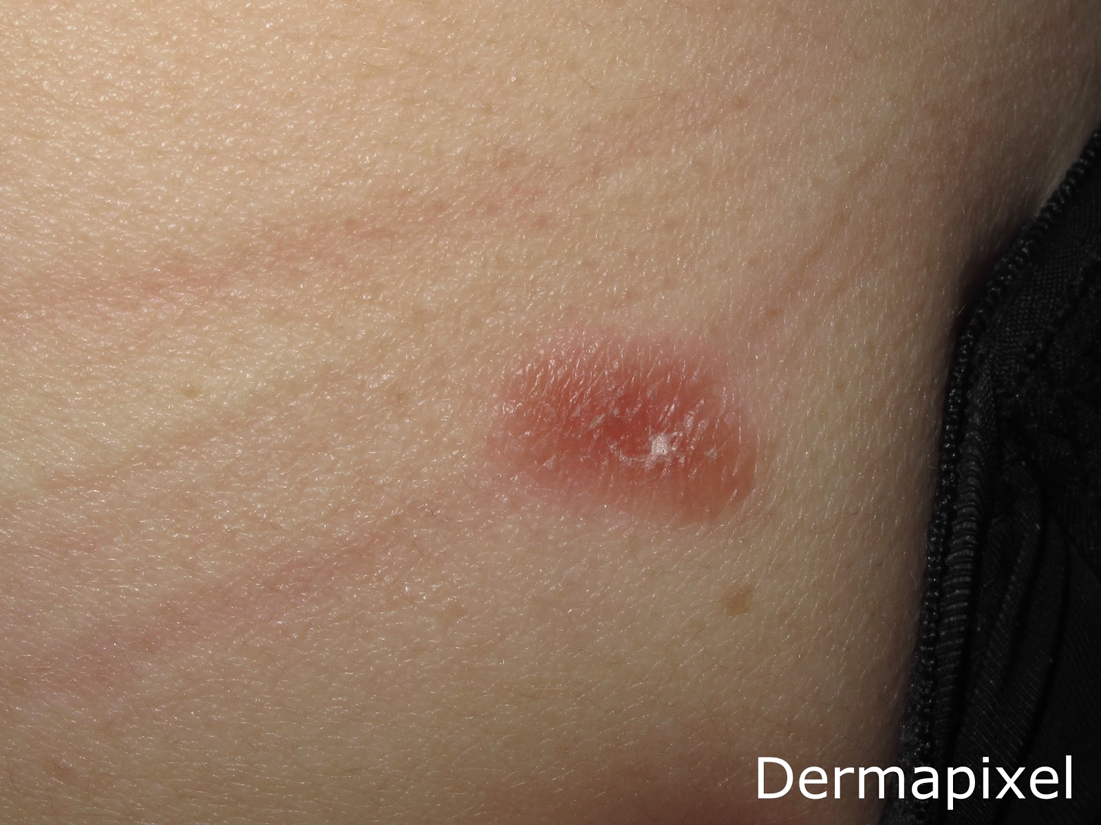 Dermapixel: noviembre 2017