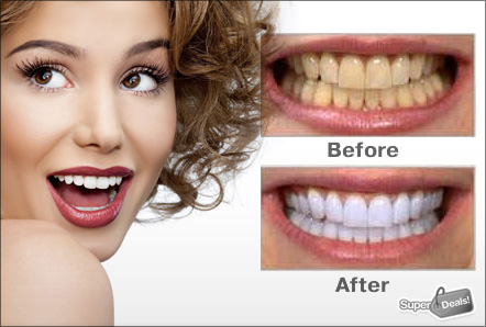 dental bleaching at home ~ Online Dental Tips