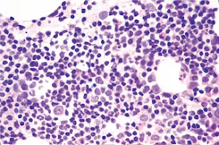 Case study (33) – Richter’s syndrome (transformation of chronic ...