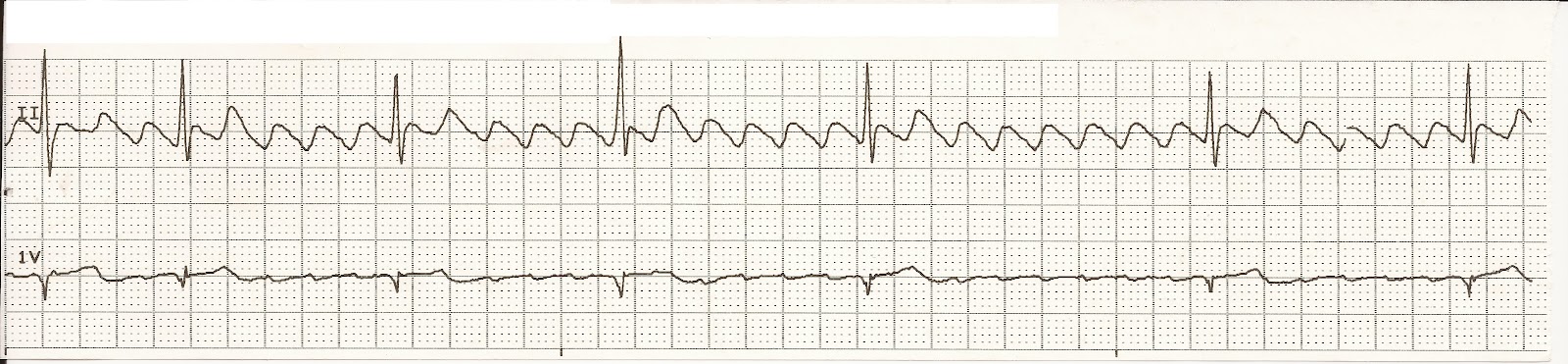 EKG Rhythm Strip Quiz 43