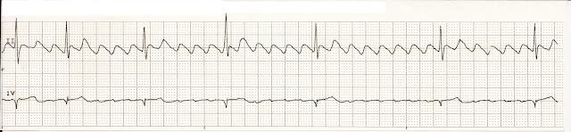 EKG Rhythm Strip Quiz 43