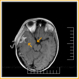Complicated Mastoiditis-MRI - Sumer's Radiology Blog