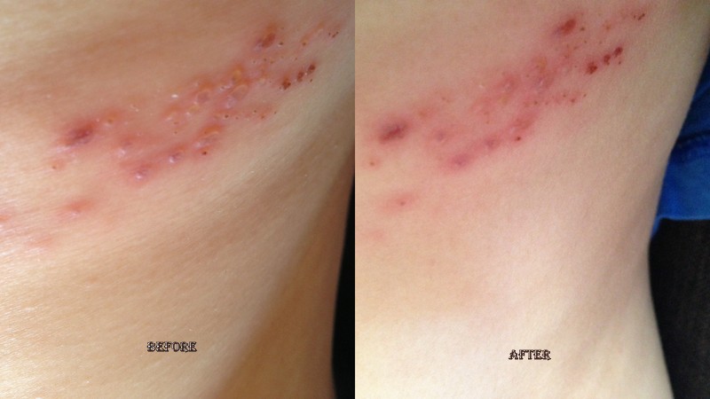 Bloop Blooop Bleeeeeep: Shingles - It starts with an itch...