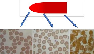 Examination of the Peripheral Blood smear