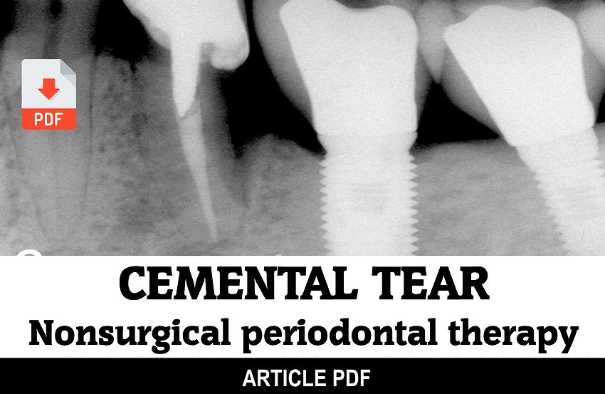 PDF: CEMENTAL TEAR - A case report with nonsurgical periodontal therapy