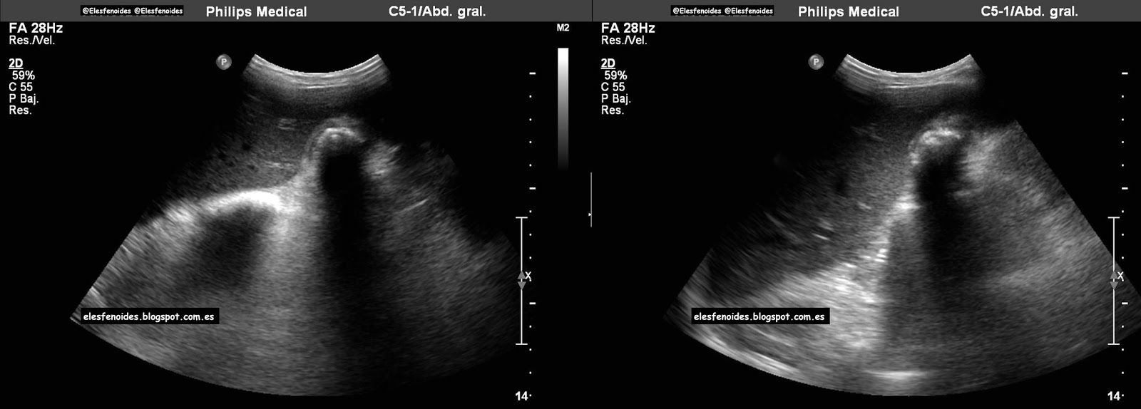 El esfenoides: Signo de WES. 2 imágenes 1 caso.