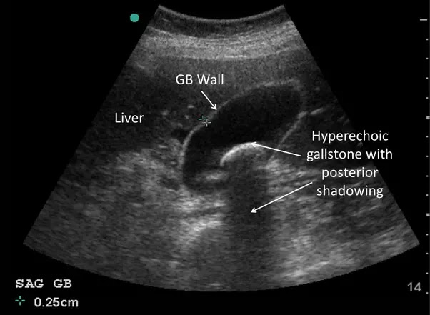 MEDICAL ULTRASOUND/GALL BLADDER STONE