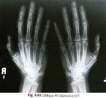Radiologia: AP OBLÍQUA BILATERAL DE MÃOS