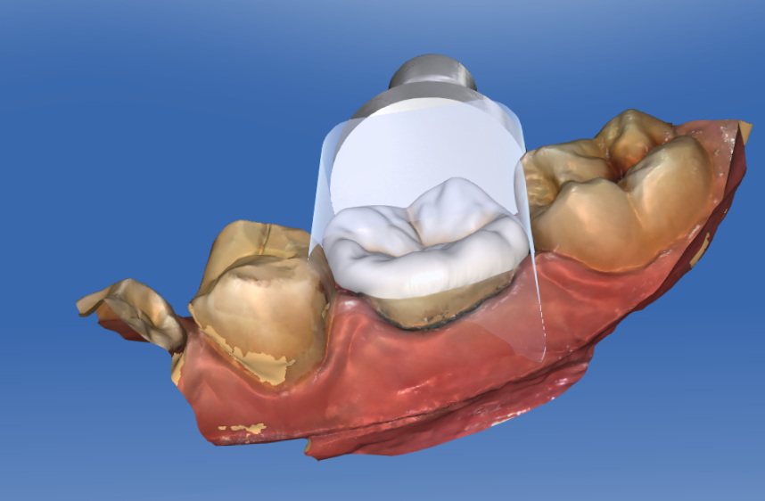 Endocrown .. Full documentation of a clinical case | Dental Esthetics