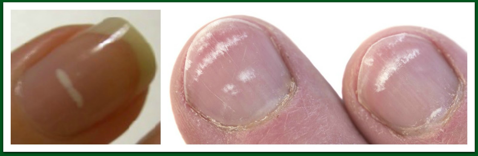 Malattie Delle Unghie Della Mano Immagini