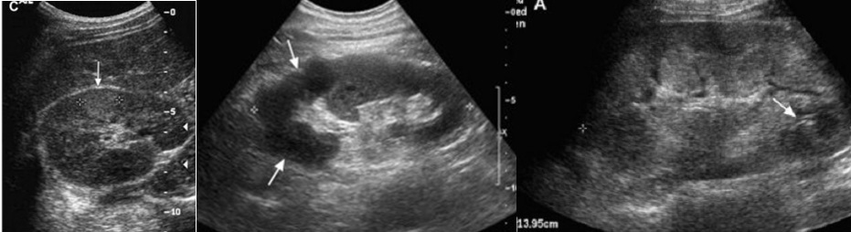 Renal Ultrasound Cases (Adrenal haemorrhage, Perinephric haematoma ...