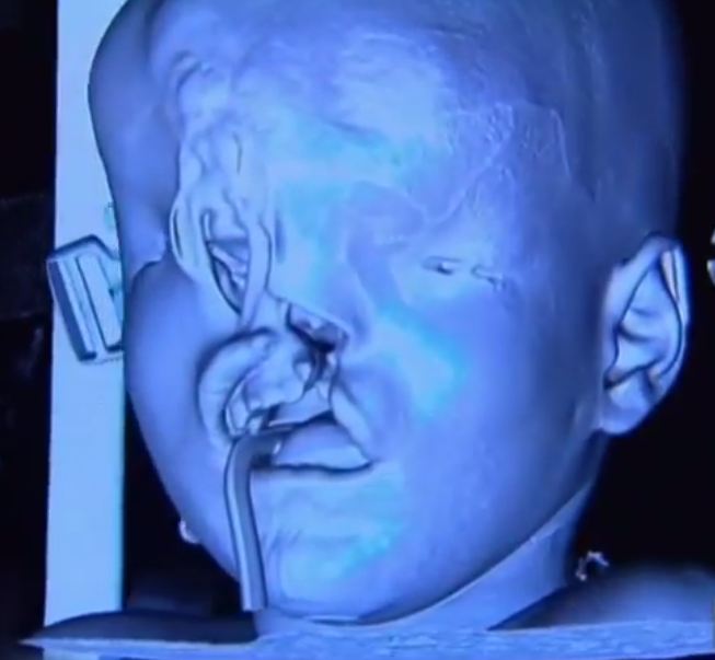 Meet Yahya : The boy with No Eyes,Nose and Upper jaw