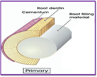 Monoblock in Endodontics [Detailed Explaination with Studies]