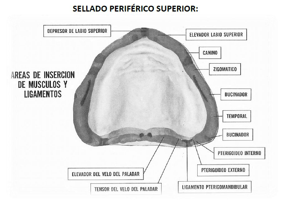 PDF: El sellado periférico en Prótesis Total