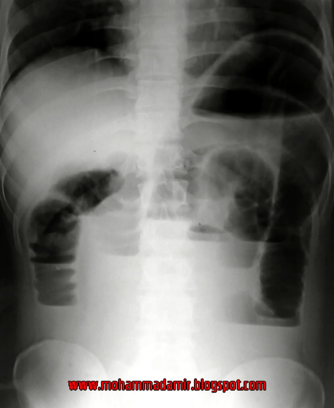 Dr. Amir's Blog: Intestinal Obstruction