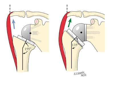 UW Shoulder and Elbow Academy: Reverse total shoulder - effects of ...