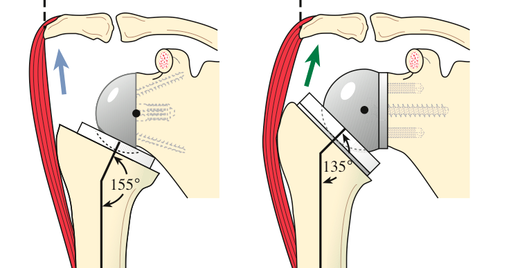 Shoulder Arthritis / Rotator Cuff Tears: causes of shoulder pain ...