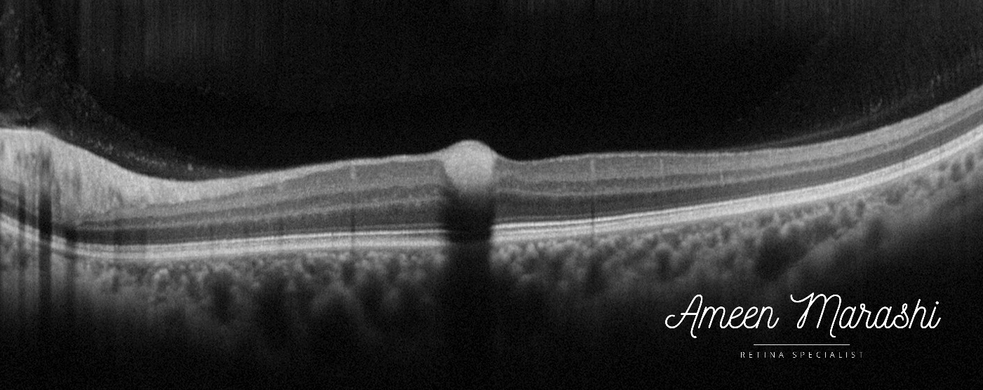 Female with subILM hemorrhage
