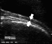 Ob/Gyn Updated : Double layer vs single layer uterine closure in ...