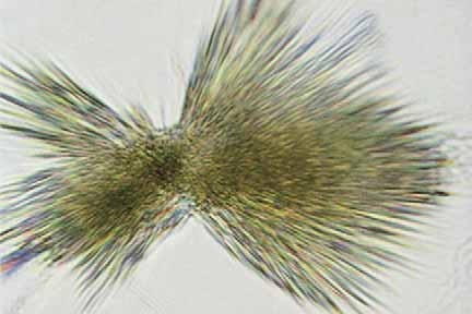 Bilirubin Crystal In Urine