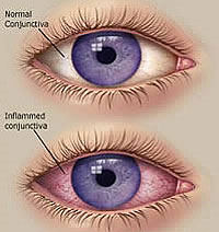 Area Information: Neonatal Conjunctivitis
