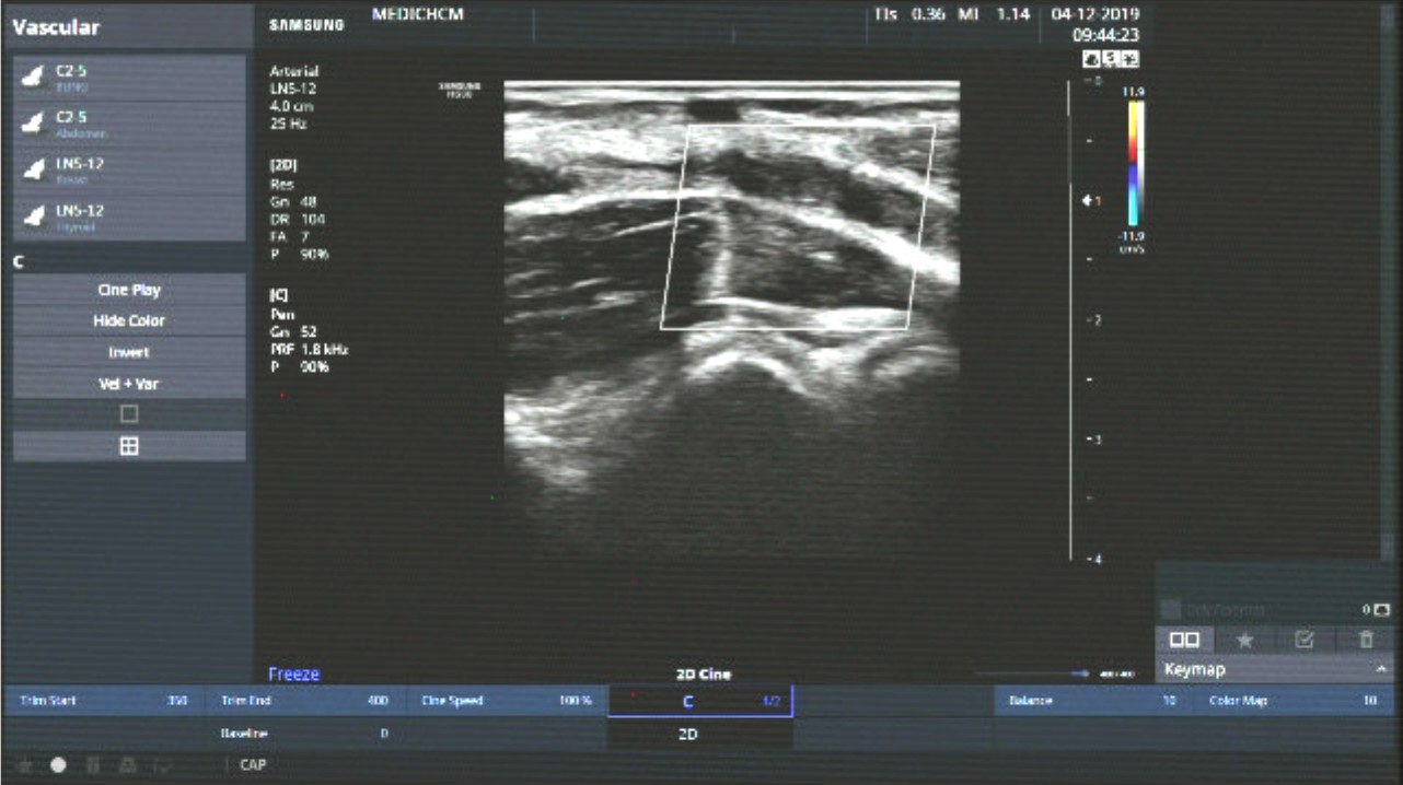 VIETNAMESE MEDIC ULTRASOUND: CASE 577: TOS (THORACIC OUTLET SYNDROME ...