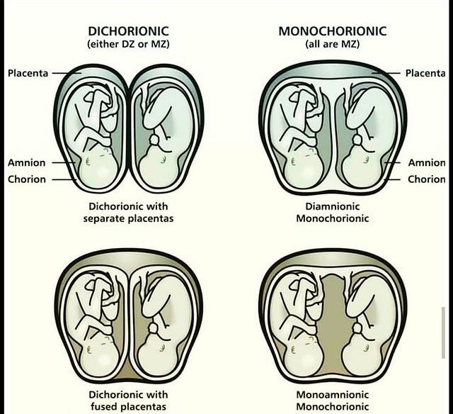 Dichorionic and monochorionic placenta