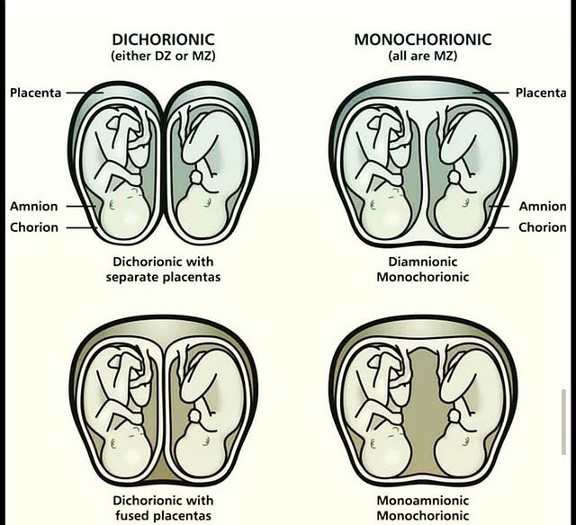 Dichorionic and monochorionic placenta