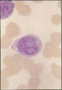 Células importantes en hematología: PROMIELOCITO