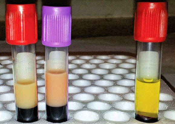 Medical Laboratory and Biomedical Science: Turbid plasma donations