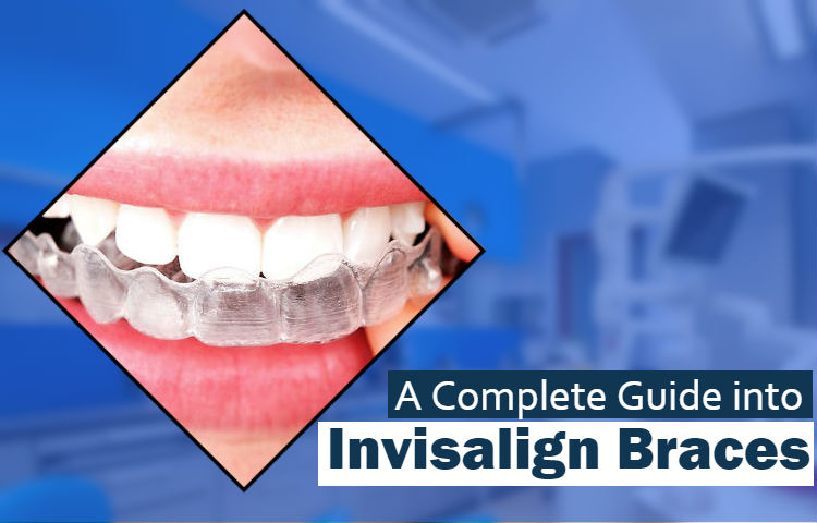 Chino Aesthetic Dental: A Complete Guide into Invisalign Braces Chino Chino Aesthetic Dental: A Complete Guide into Invisalign Braces Chino