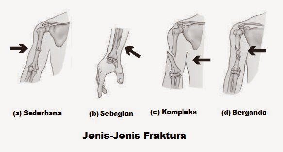 Jenis Patah Tulang