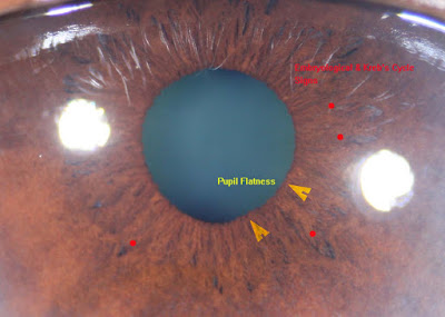 Modern & Multidimensional Iridology: Pupil Flatness & Internal ...